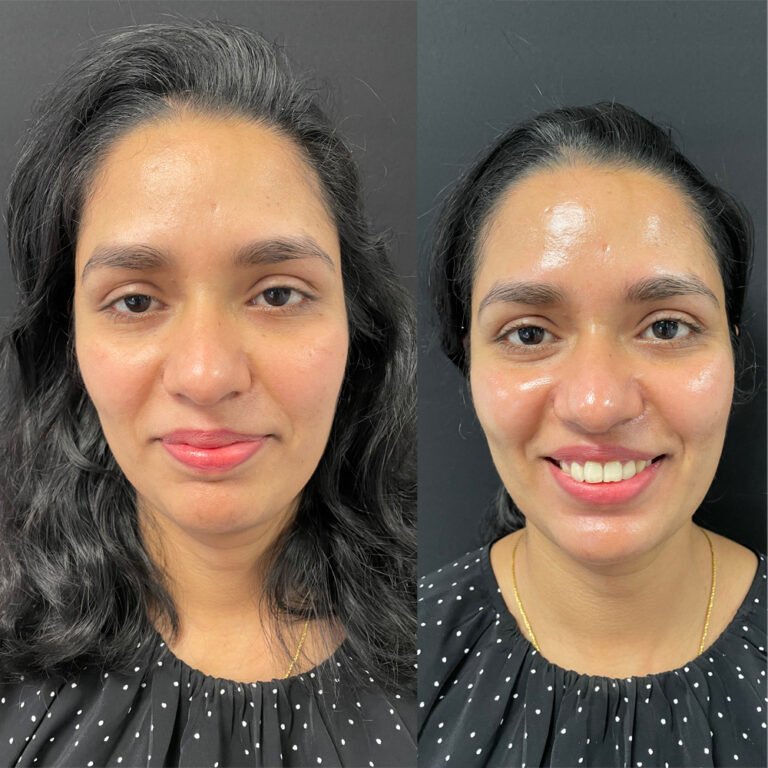 Hydrafacial Before And After: Does It Really Work?