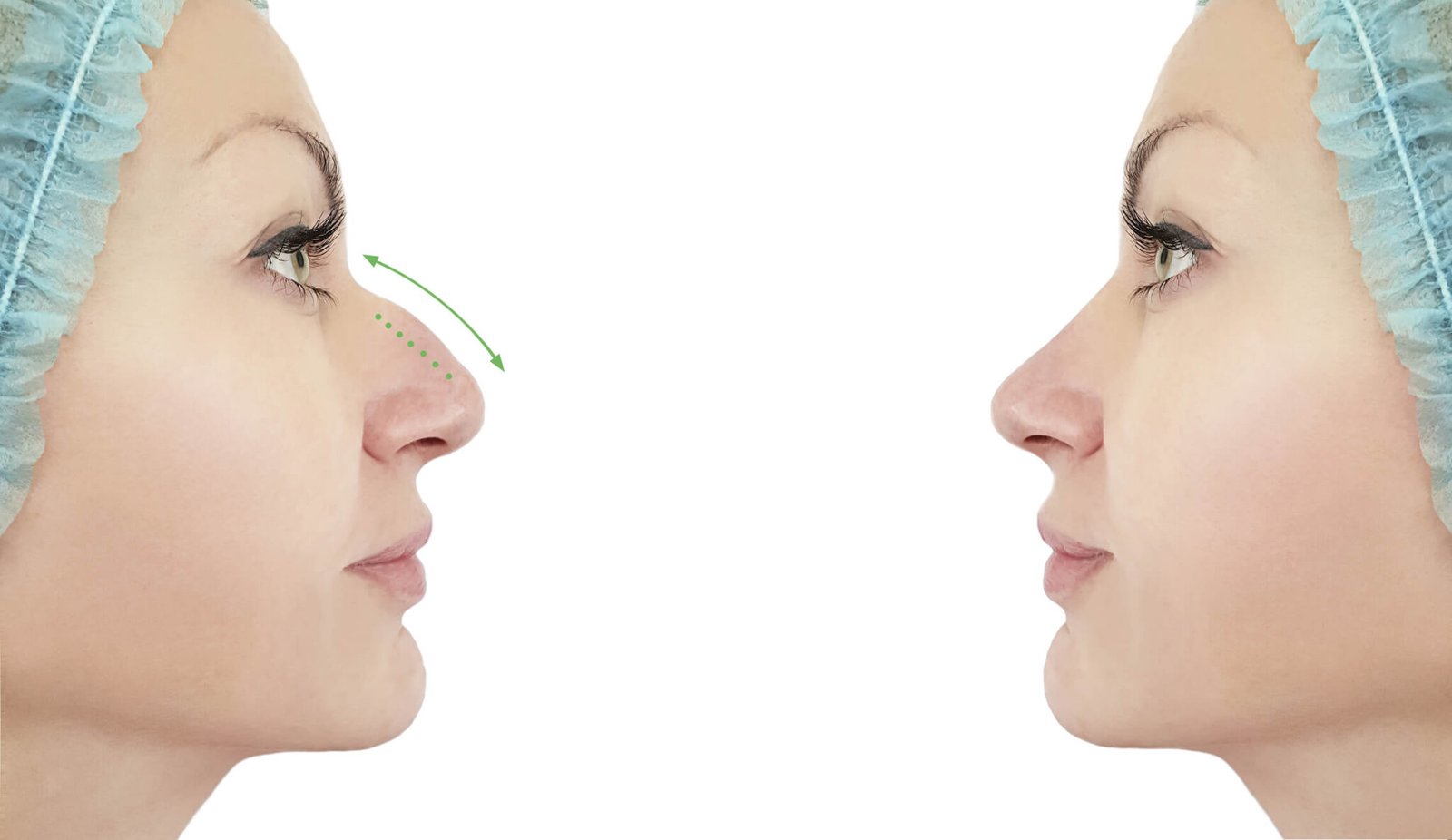 Hawk Nose - Comparison With Other Types Of Noses
